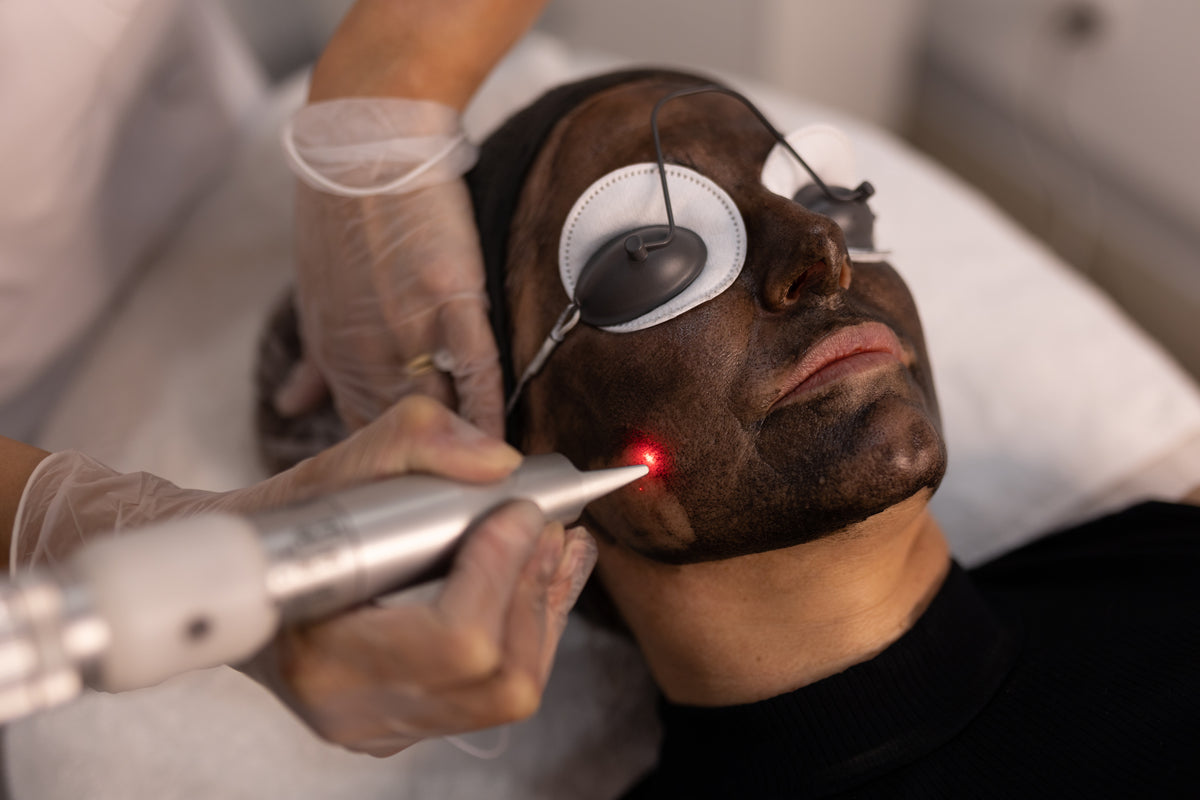 Carbon Laser Facial – My Laser Clinic